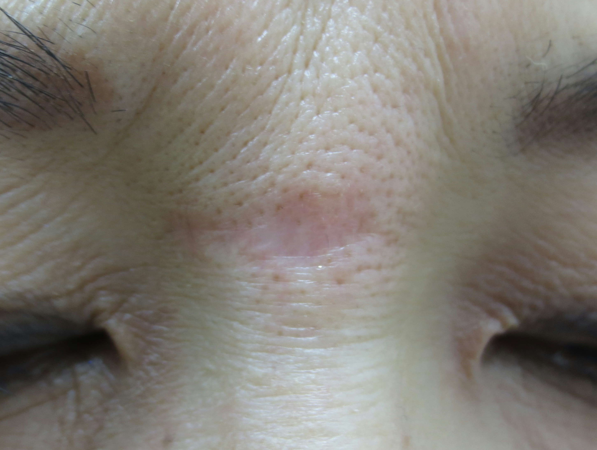 傷跡 傷の陥没 へこみに プラズマNeoGen evo ＆TCAダーマピール – 八丁堀 皮膚科｜スキンソリューションクリニック