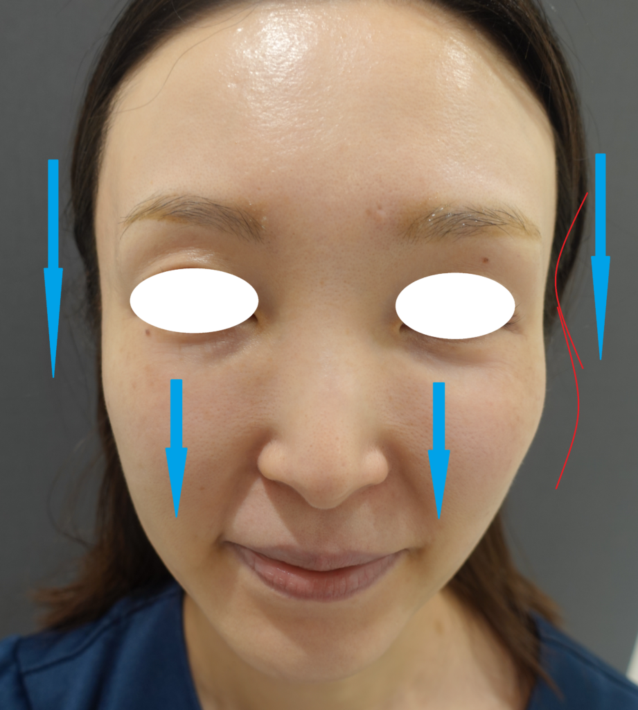 こめかみがやせると頬骨にたるみがたまって頬骨が出て見えます。mwデュアルリフト®中顔面リフトでこめかみにたるみを戻すと輪郭が綺麗になります