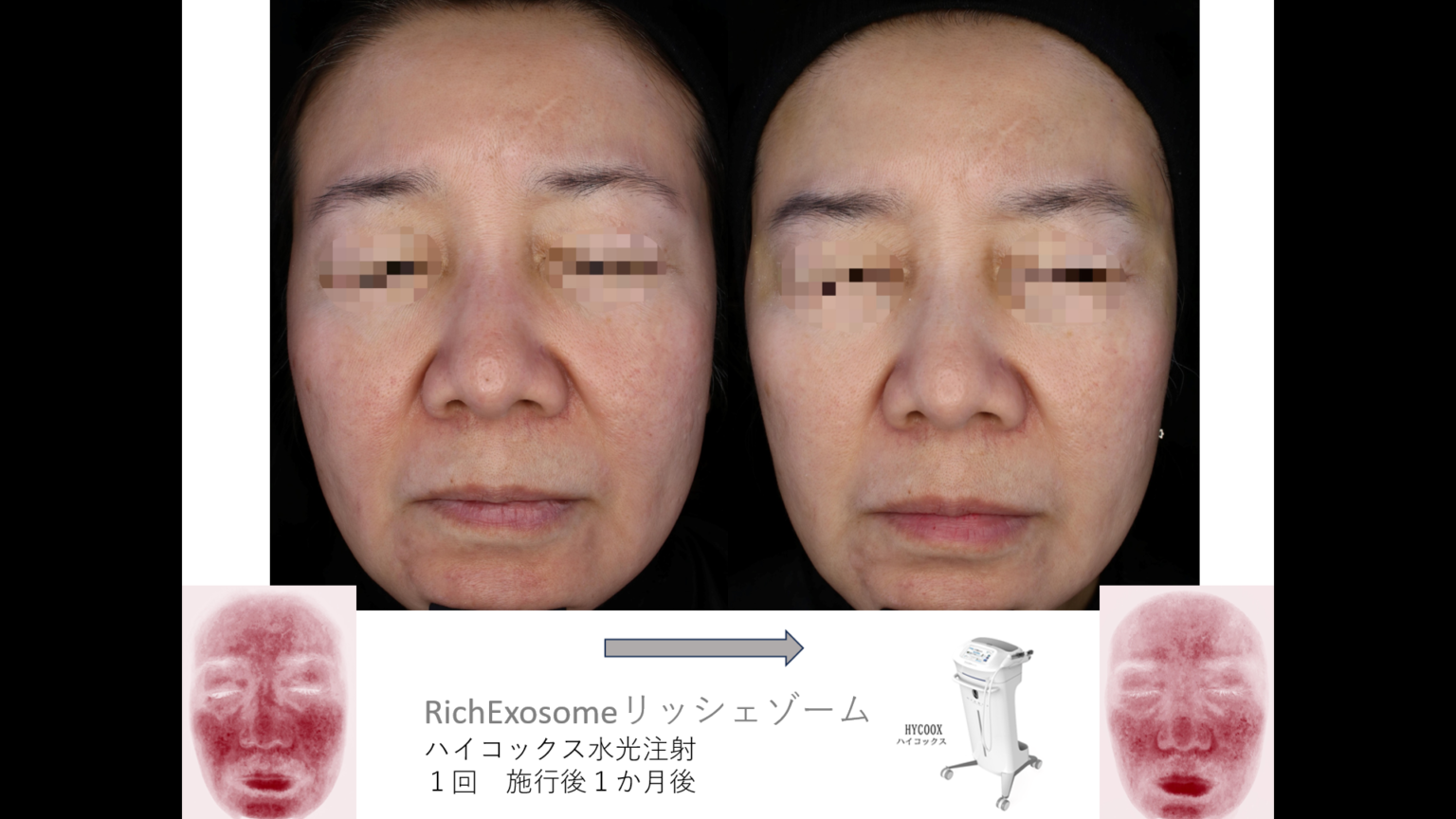 たった1回の治療でもこんなに肌が変わる 「richexosomeリッシェゾーム」のハイコックス水光注射 南青山 皮膚科|スキン
