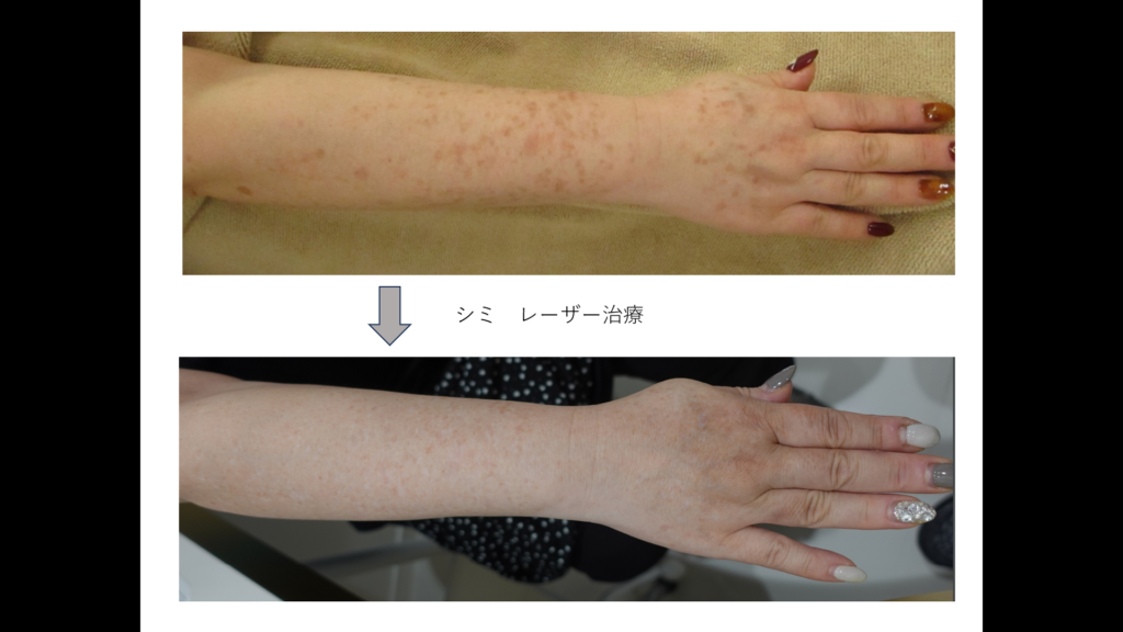手のシミ治療 腕のシミ治療 – 南青山 皮膚科｜スキンソリューションクリニック青山通り
